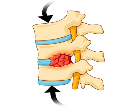 Vertebral Compression Fracture - Florida Advanced Spine and Orthopedics